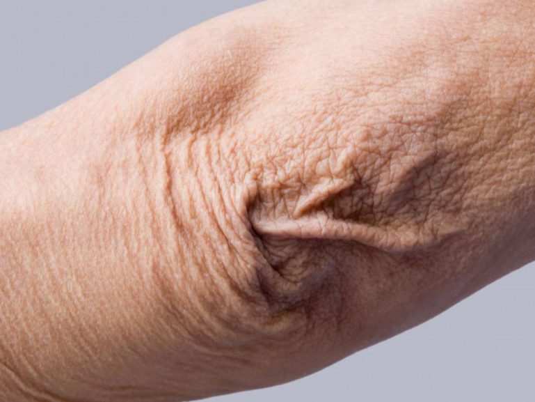 Difference Between Crepe Skin And Cellulite? (Guide) - Cheaperks